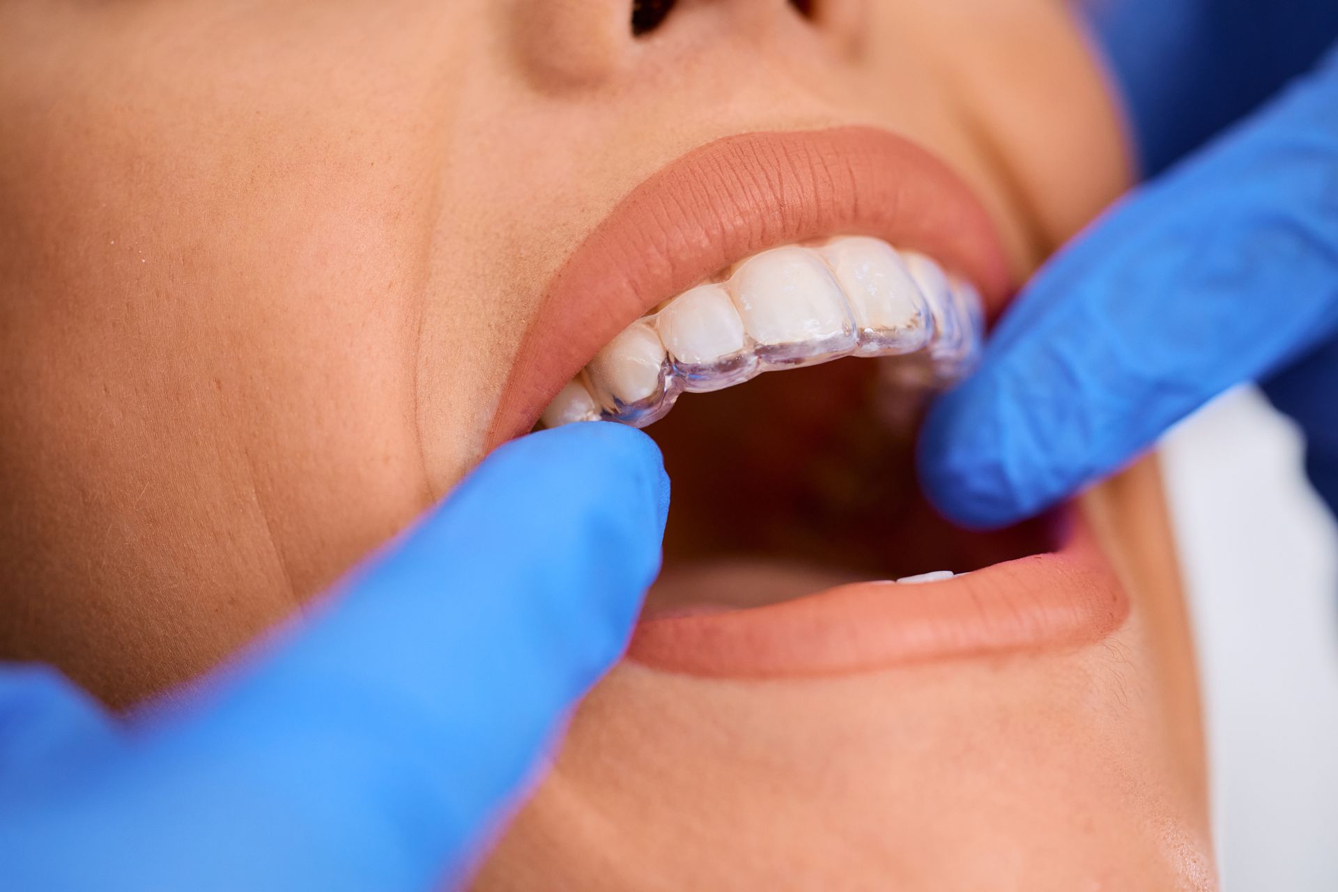 The Benefits and Advantages of Invisalign: A Definitive Guide