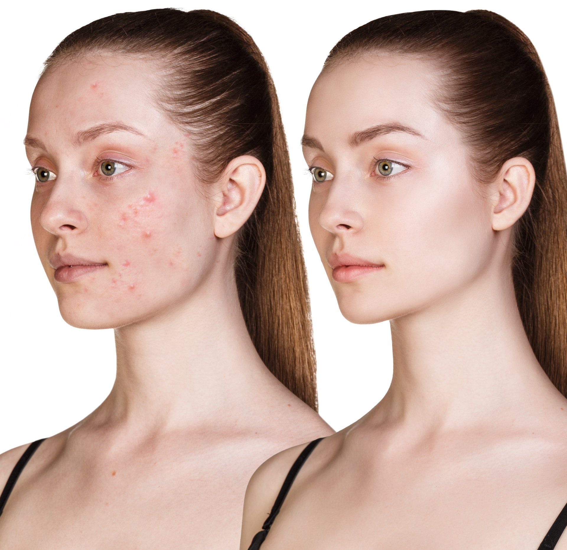 How to Clear Acne - 10 Easy Steps