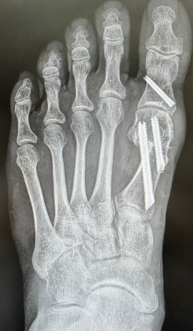 Xray Of Foot With Bunion