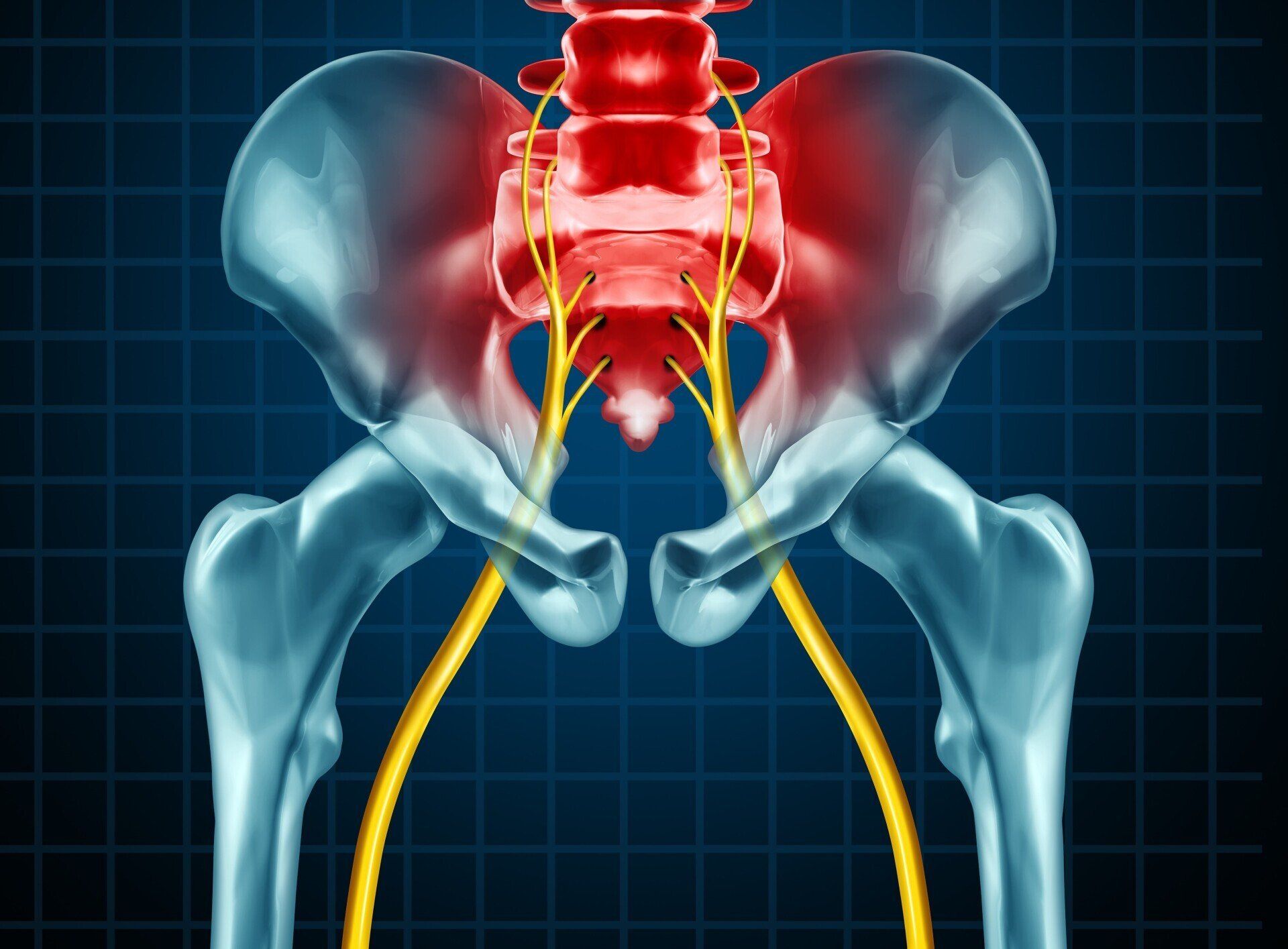 What is sciatica, and can chiropractic help?