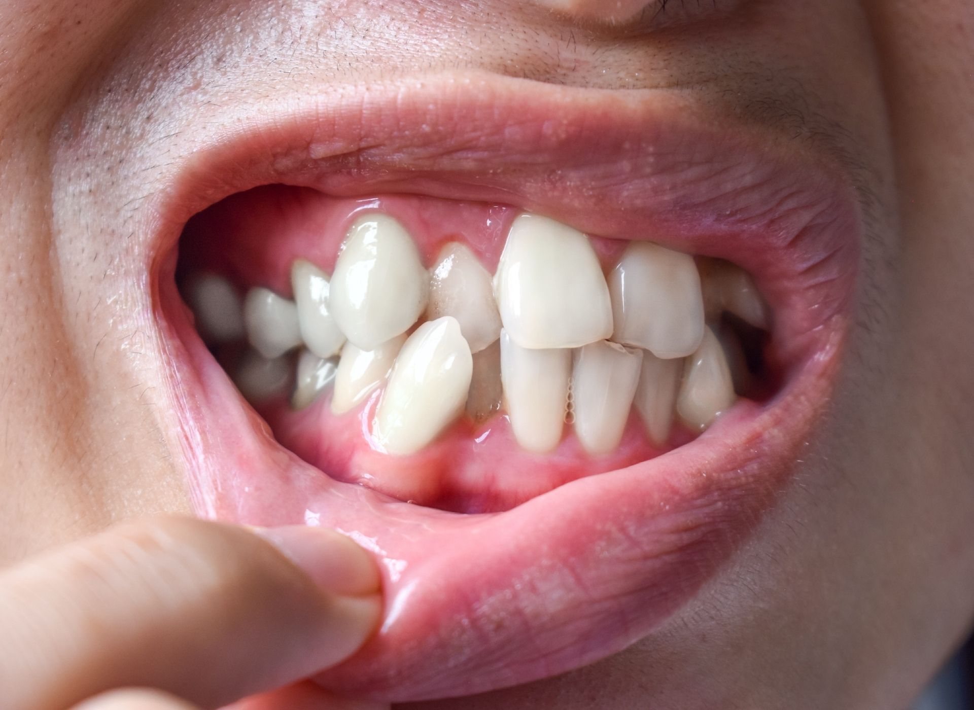 Misaligned Teeth | What Causes Crooked Teeth?