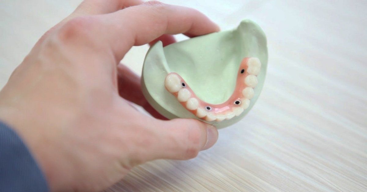 Everything You Need to Know About All-on-4s