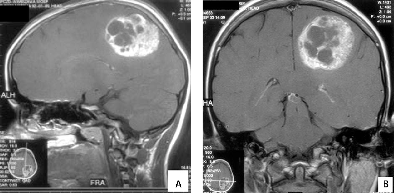 What is an Ependymoma Tumor?
