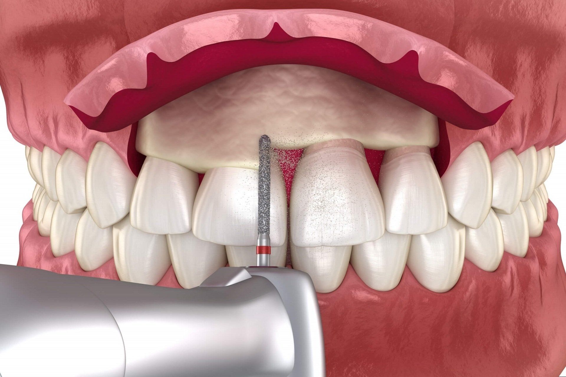 What Is Bone Grafting For Dental Implants 