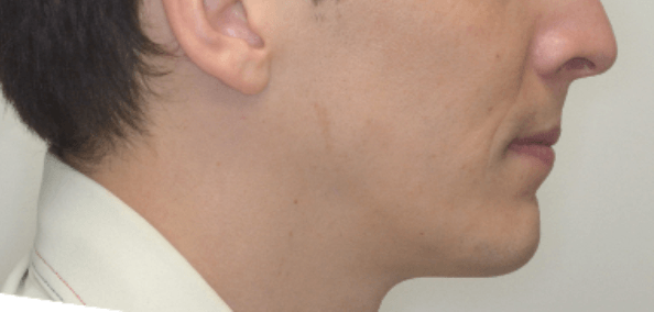 Genioplasty Surgery - Chin Surgery or Implant Surgery