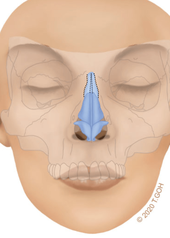 Nasal Bone Reduction This Patient Came In Unhappy With His Hump And