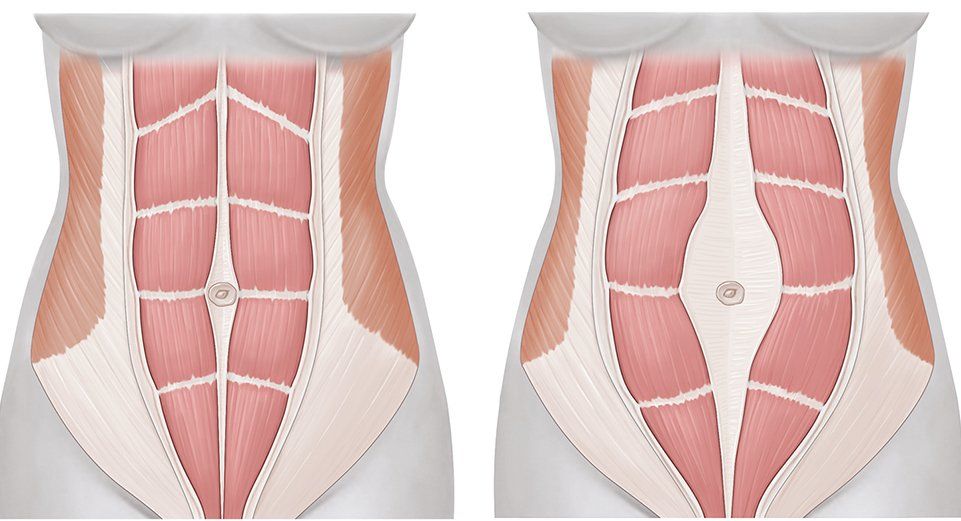 Diastasis Rectus Abdominus