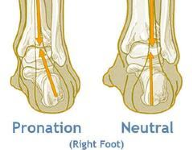 Ankle Pronation Surgery