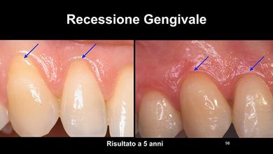 Recessione gengive | L'Aquila, AQ | Studio Dentistico Orsini