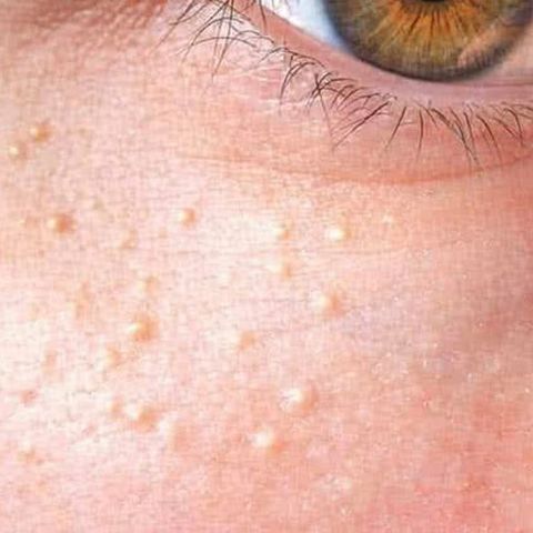 Skin Lesions | Cherie Ramsay Aesthetics & Electrolysis