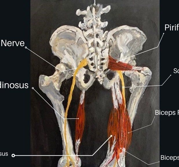 Differentiation of Hamstring Tendonitis and Strains Vs. Hamstring Syndrome.
