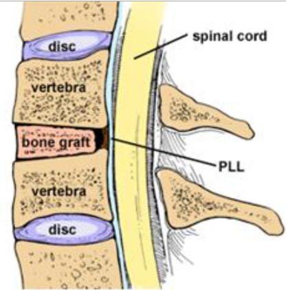 Anterior Cervical Discectomy and Fusion (ACDF)| OrthoSpine Advance ...