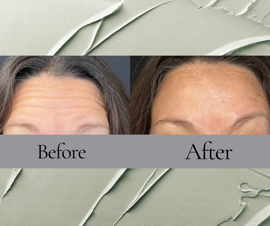 Botox | Winter Springs & Oviedo, FL | Maki Medspa & Wellness
