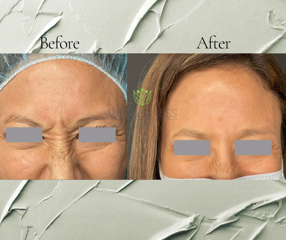 Botox | Winter Springs & Oviedo, FL | Maki Medspa & Wellness