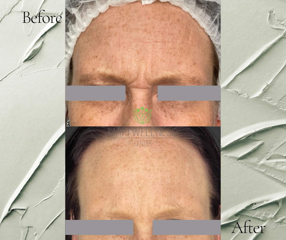 Botox | Winter Springs & Oviedo, FL | Maki Medspa & Wellness