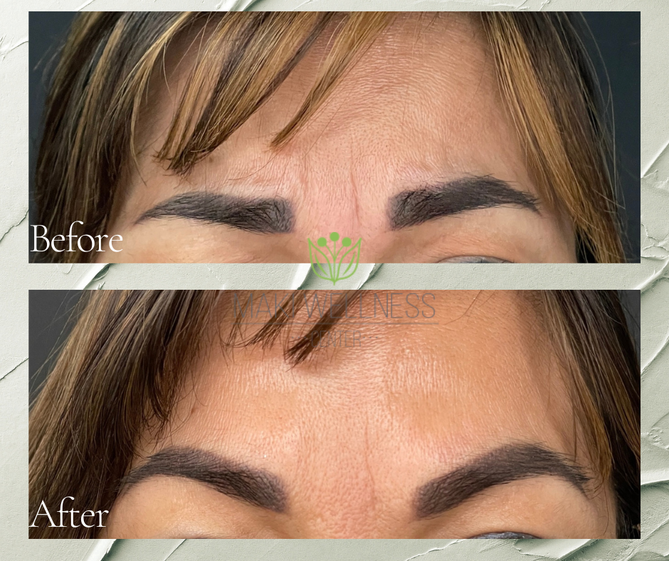 Botox | Winter Springs & Oviedo, FL | Maki Medspa & Wellness