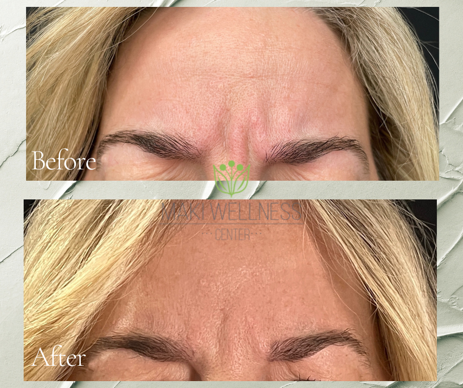 Botox | Winter Springs & Oviedo, FL | Maki Medspa & Wellness