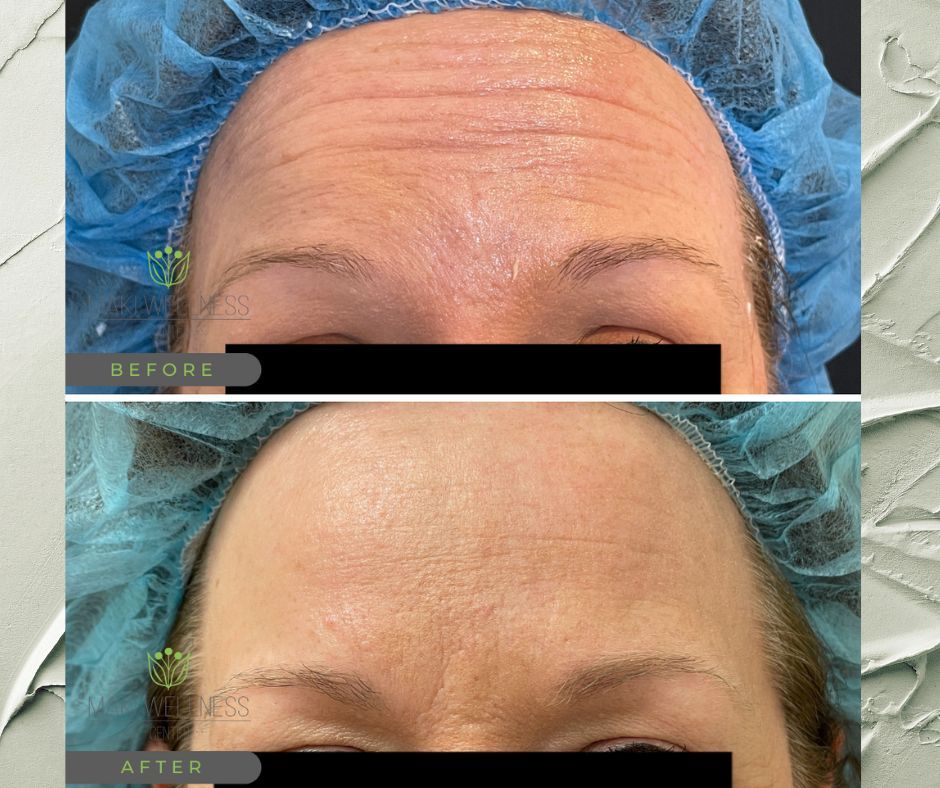 Botox | Winter Springs & Oviedo, FL | Maki Medspa & Wellness
