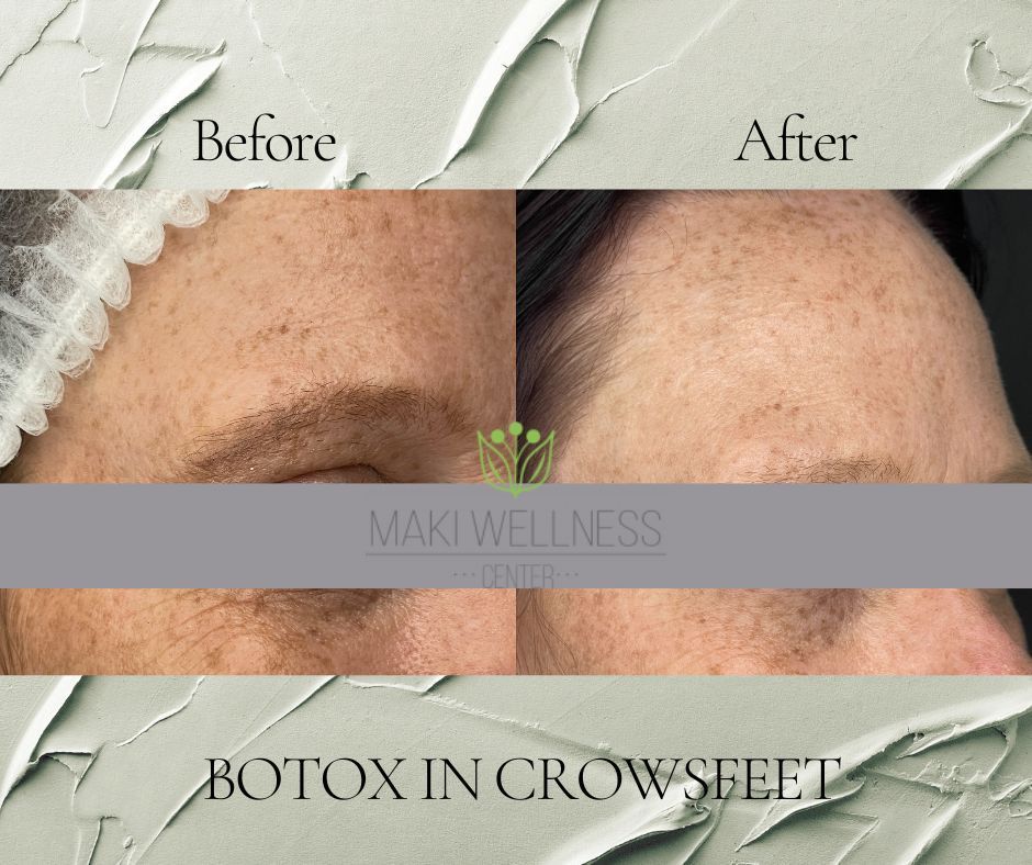 Botox | Winter Springs & Oviedo, FL | Maki Medspa & Wellness