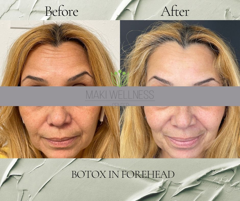Botox | Winter Springs & Oviedo, FL | Maki Medspa & Wellness