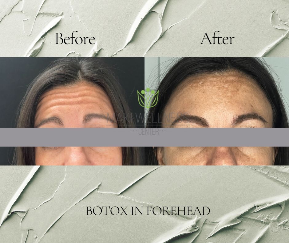 Botox | Winter Springs & Oviedo, FL | Maki Medspa & Wellness