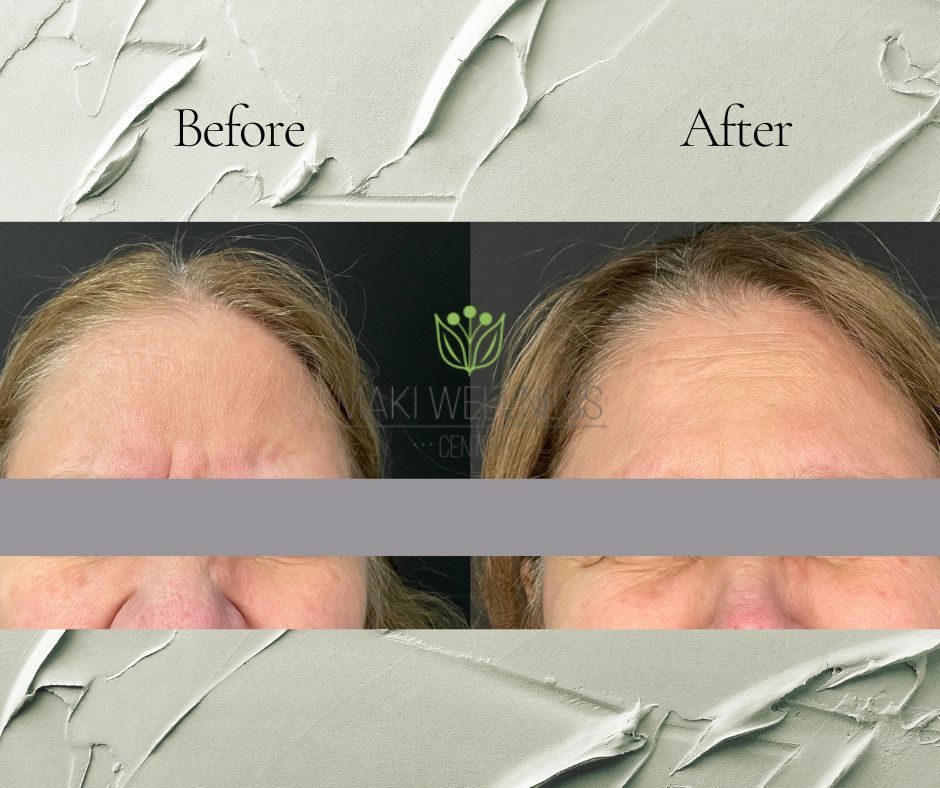 Botox | Winter Springs & Oviedo, FL | Maki Medspa & Wellness