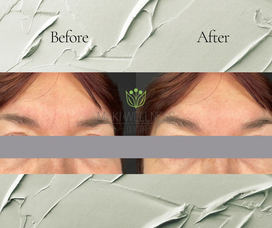 Botox | Winter Springs & Oviedo, FL | Maki Medspa & Wellness