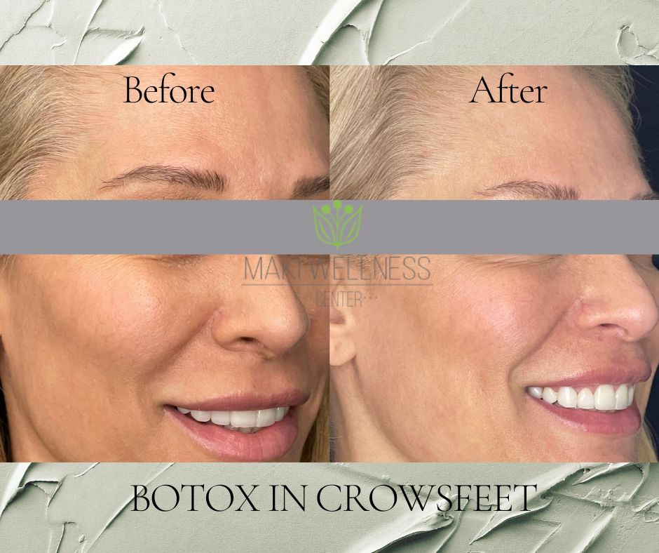 Botox | Winter Springs & Oviedo, FL | Maki Medspa & Wellness