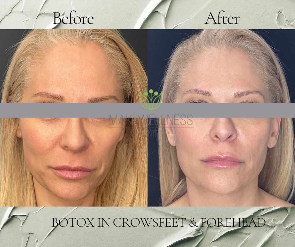 Botox | Winter Springs & Oviedo, FL | Maki Medspa & Wellness