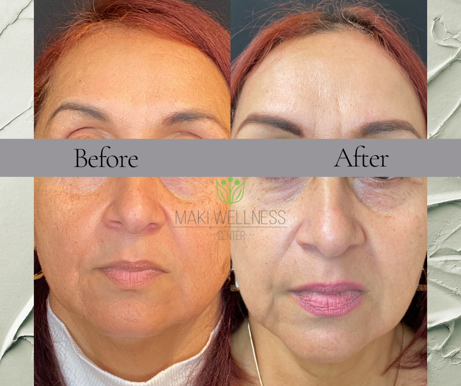 PDO Threading | Non-Surgical Facelift | Maki Wellness Center