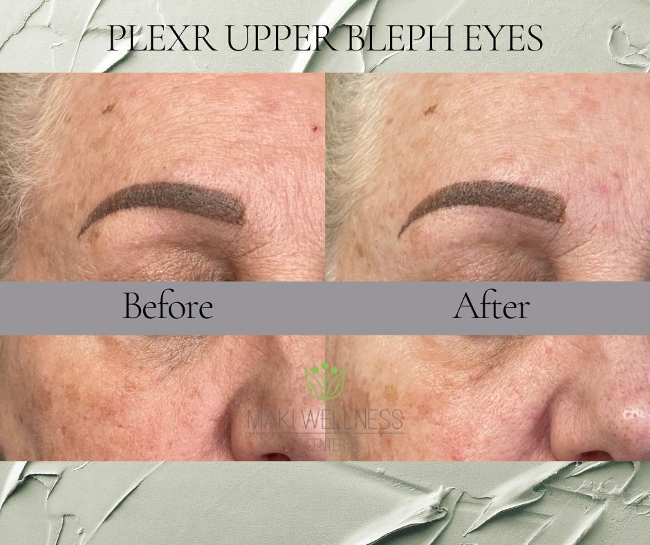 Plexr Plasma Treatments | Winter Springs & Oviedo, FL
