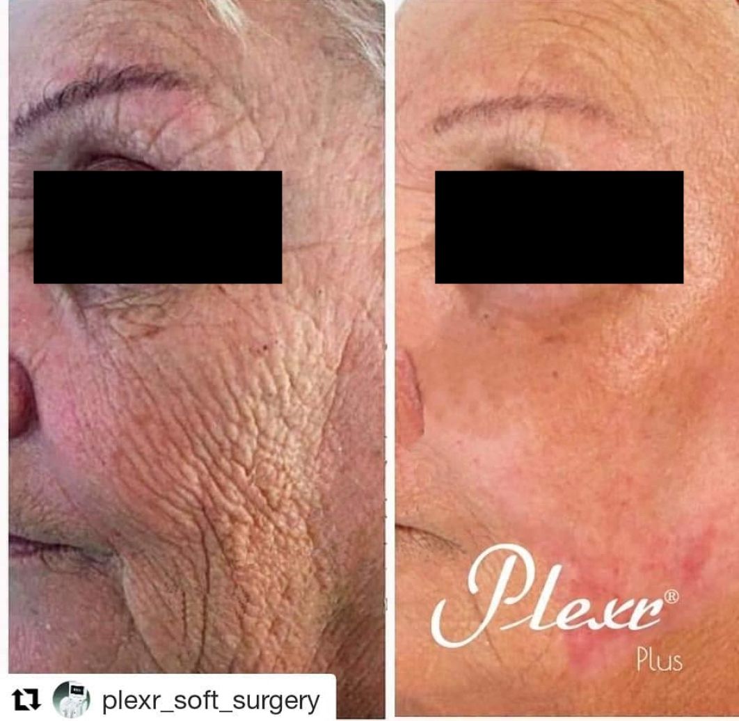 Plexr Plasma Treatments | Winter Springs & Oviedo, FL