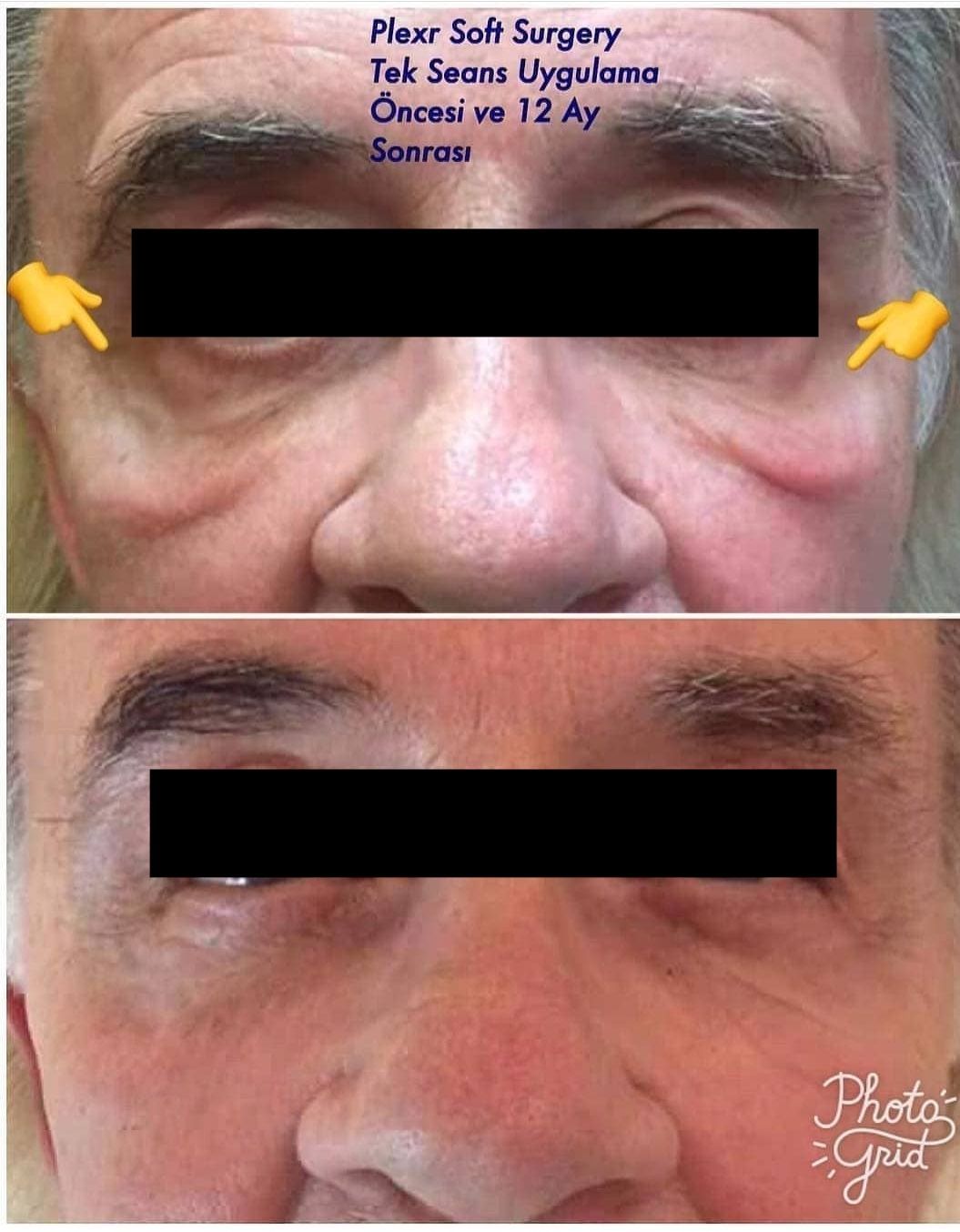 Plexr Plasma Treatments | Winter Springs & Oviedo, FL