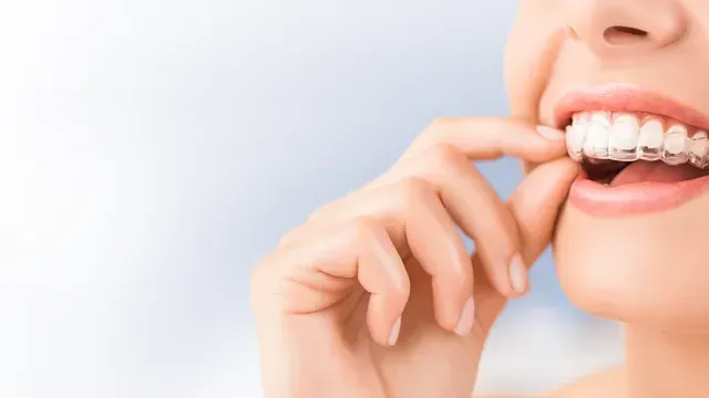 How Does Invisalign Work?