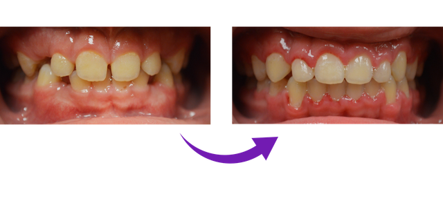 Impacted Front Teeth
