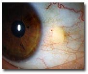 What are those yellow bumps on my eyes? Pingueculae is a Harmless Eye ...