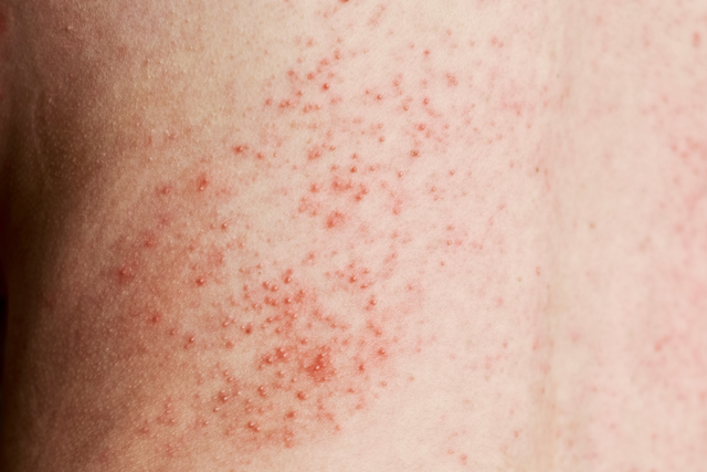 Health Skin Rashes