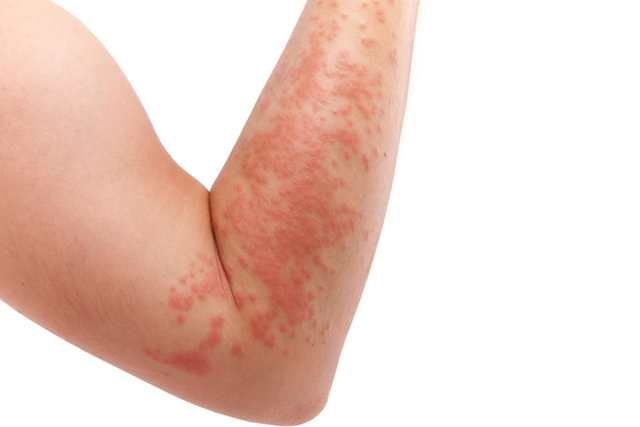 What Can Cause Skin Rash And Swelling - Infoupdate.org