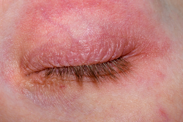 Nummular Eczema On Face Causes