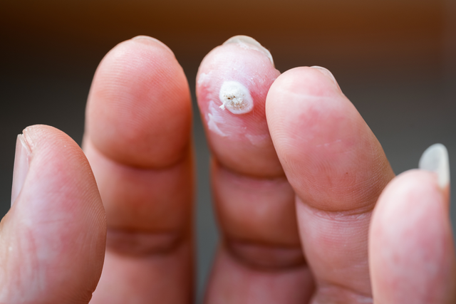 Pictures Of Warts On Your Fingers - Infoupdate.org