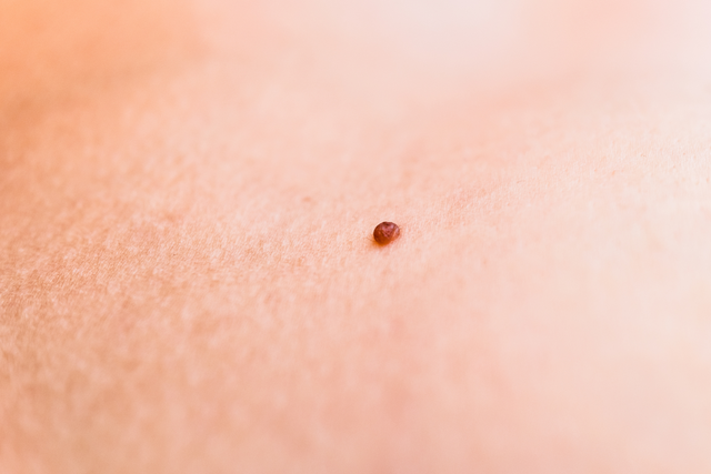 Nasal Wart Hpv