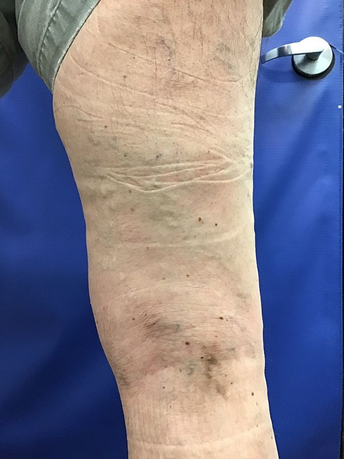 ClosureFast™ TreatsChronic Venous Insufficiency - Athens Veins