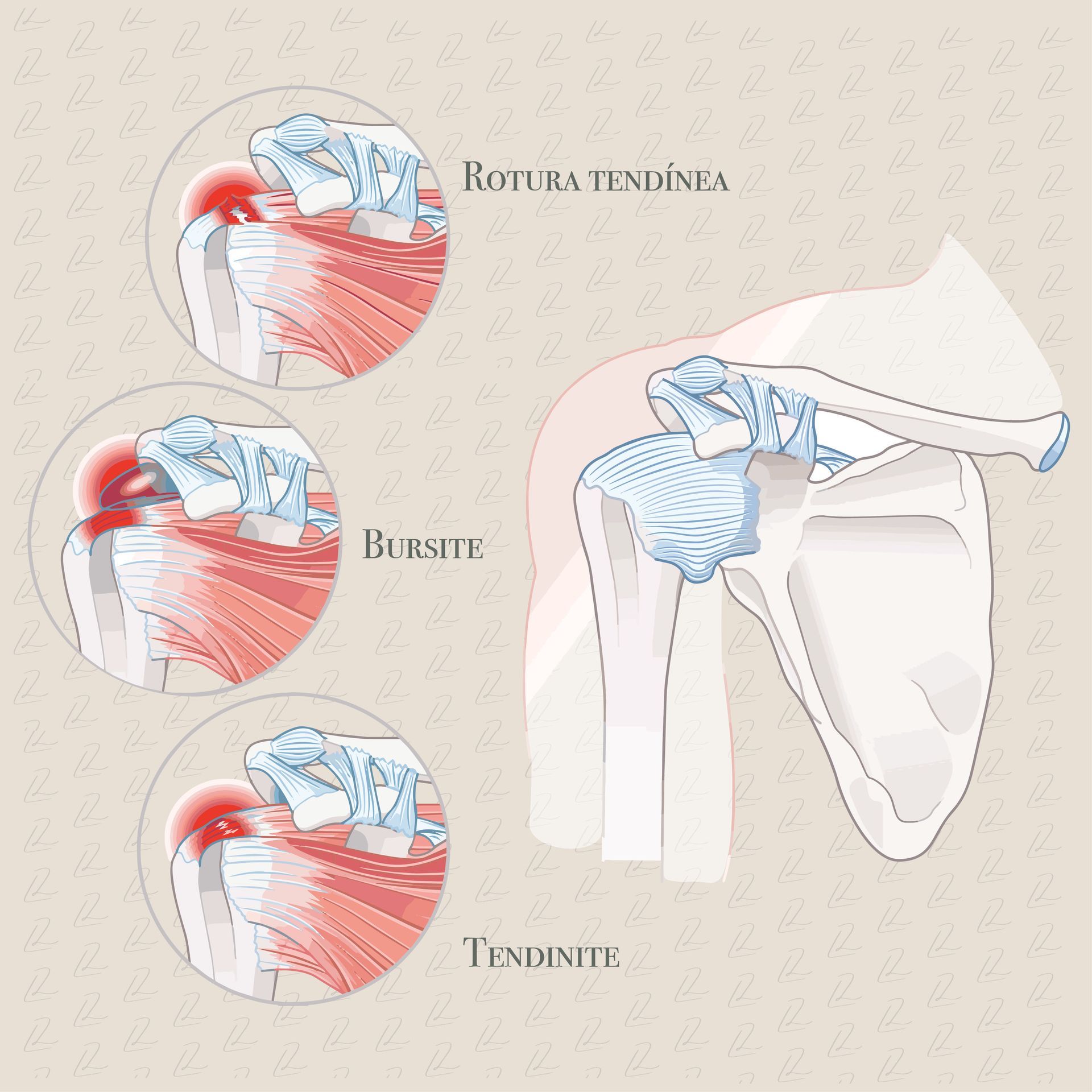 O que é tendinopatia do manguito rotador?