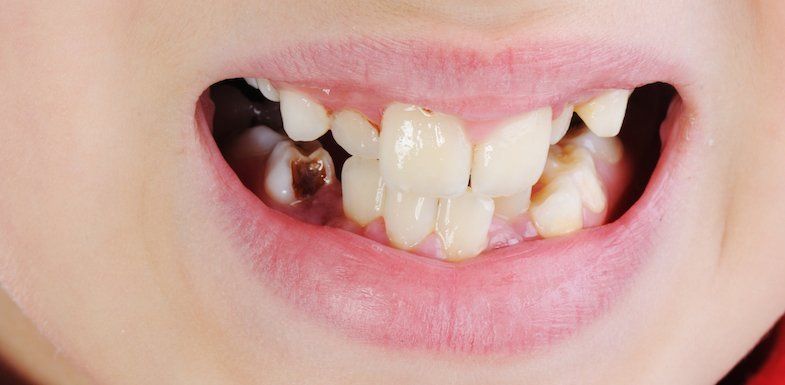 Causes of Tooth Decay & How to Stop It