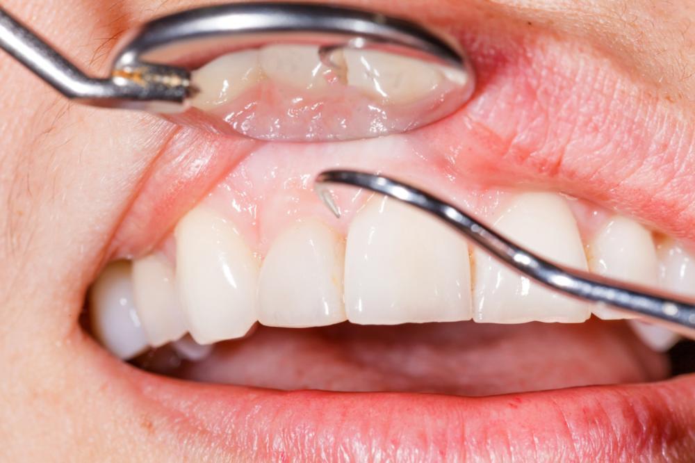 Deep Teeth Cleaning: Everything You Need To Know