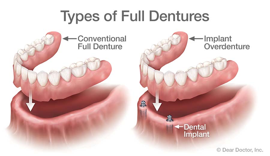 The Three types of Complete Dentures
