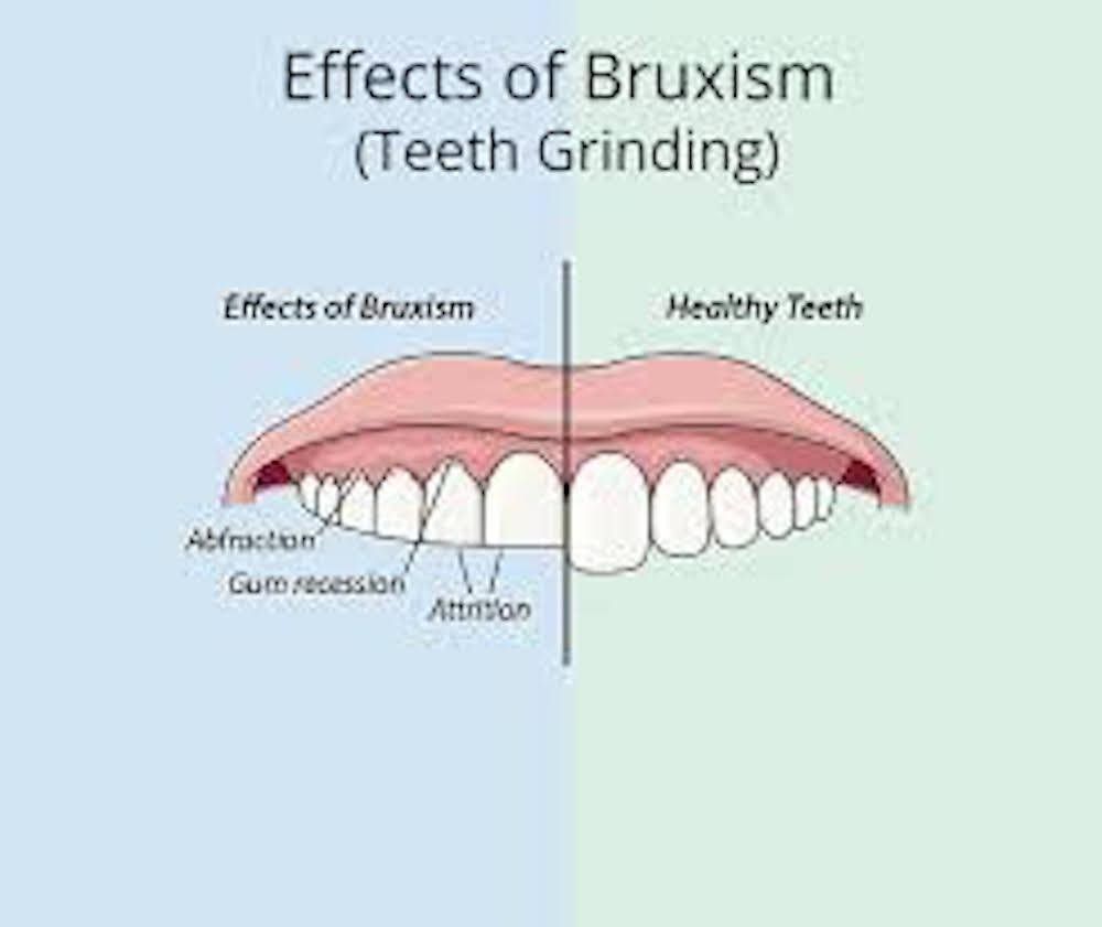 What Causes Bruxism, and Can it Be Fixed?
