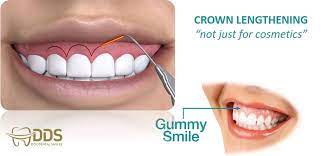What is Crown Lengthening?