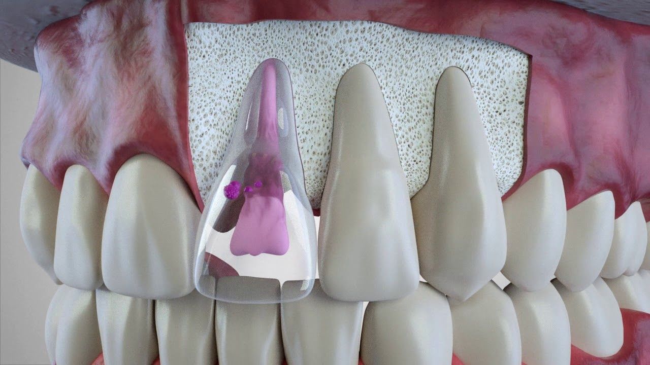 What is Root Resorption?