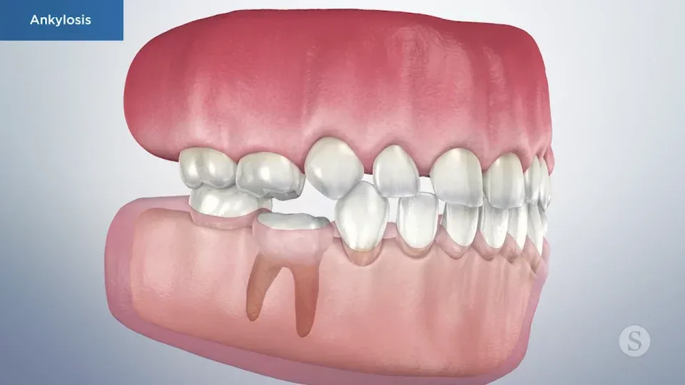 What is an Ankylosed Tooth?